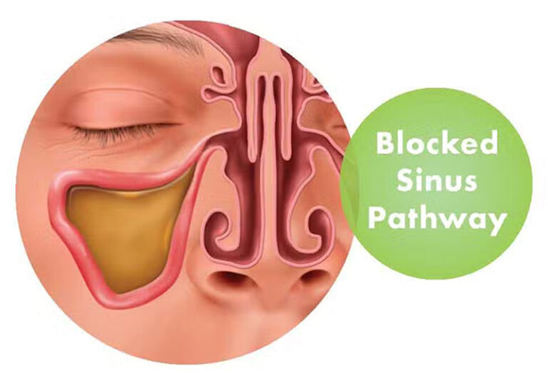 Balloon Sinuplasty - ENT Specialist St Louis - Sinus Allergy & Sleep ...